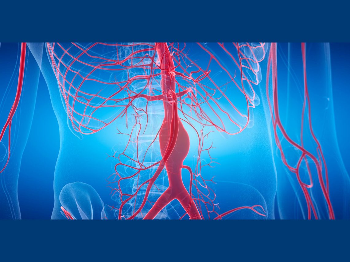 Anévrisme de l'aorte | Chirurgie vasculaire et endocrinienne
