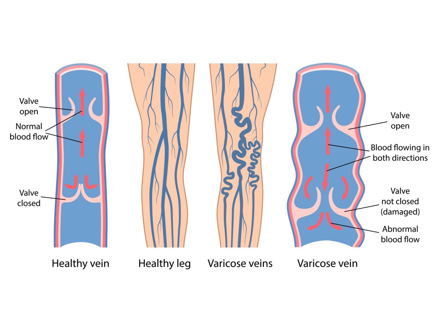 Varices | Chirurgie vasculaire et endocrinienne
